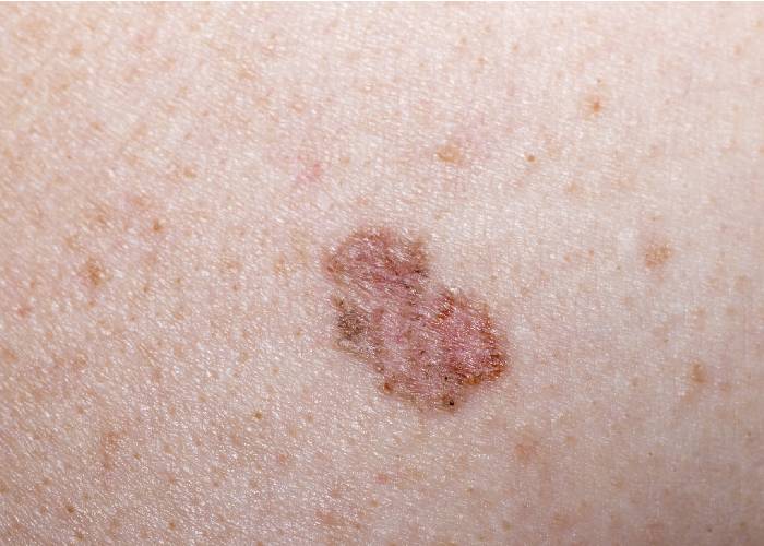 Sun protection and skin cancer - Introduction & module overview